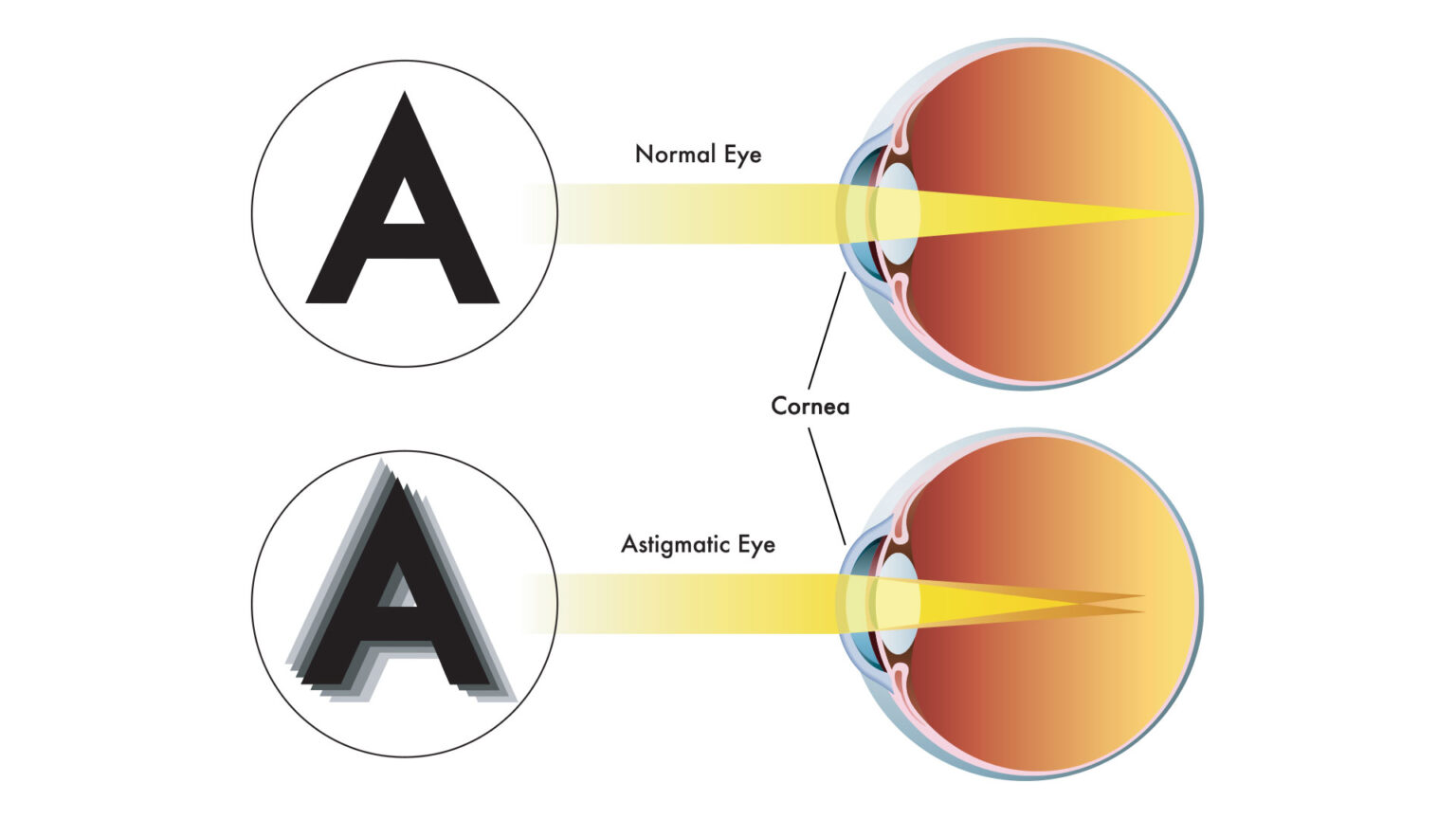 Conquering Astigmatism After Cataract Surgery: Expert Guide