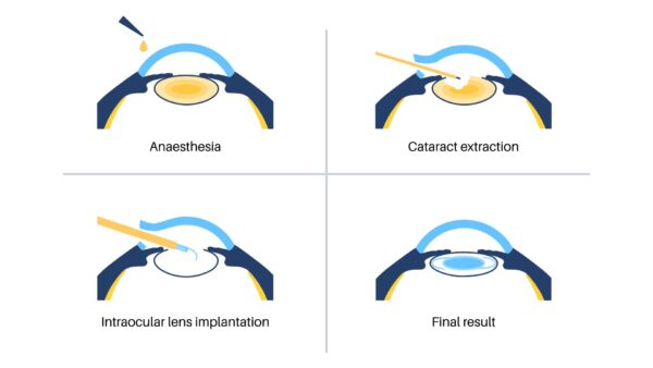 FLACS: Revolutionising Cataract Surgery in London