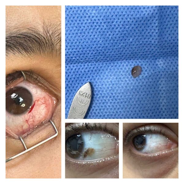 Blue Fin Vision® | Conjunctival Naevus Removal on Harley Street, London
