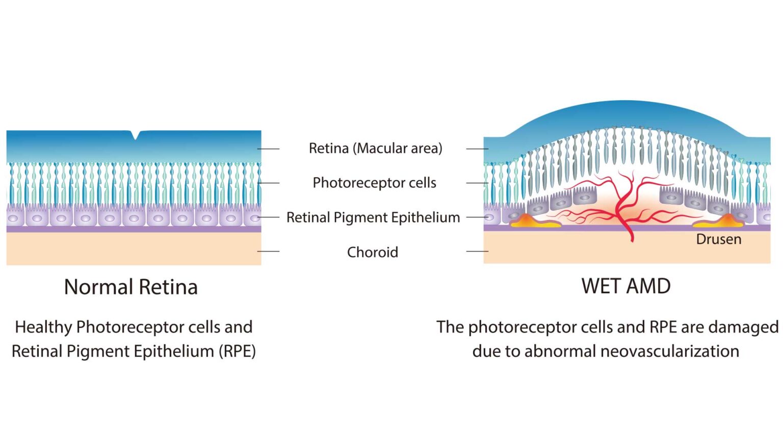 Wet AMD Explained: Insights from Harley Street Experts