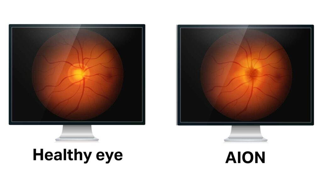 Understanding Anterior Ischaemic Optic Neuropathy