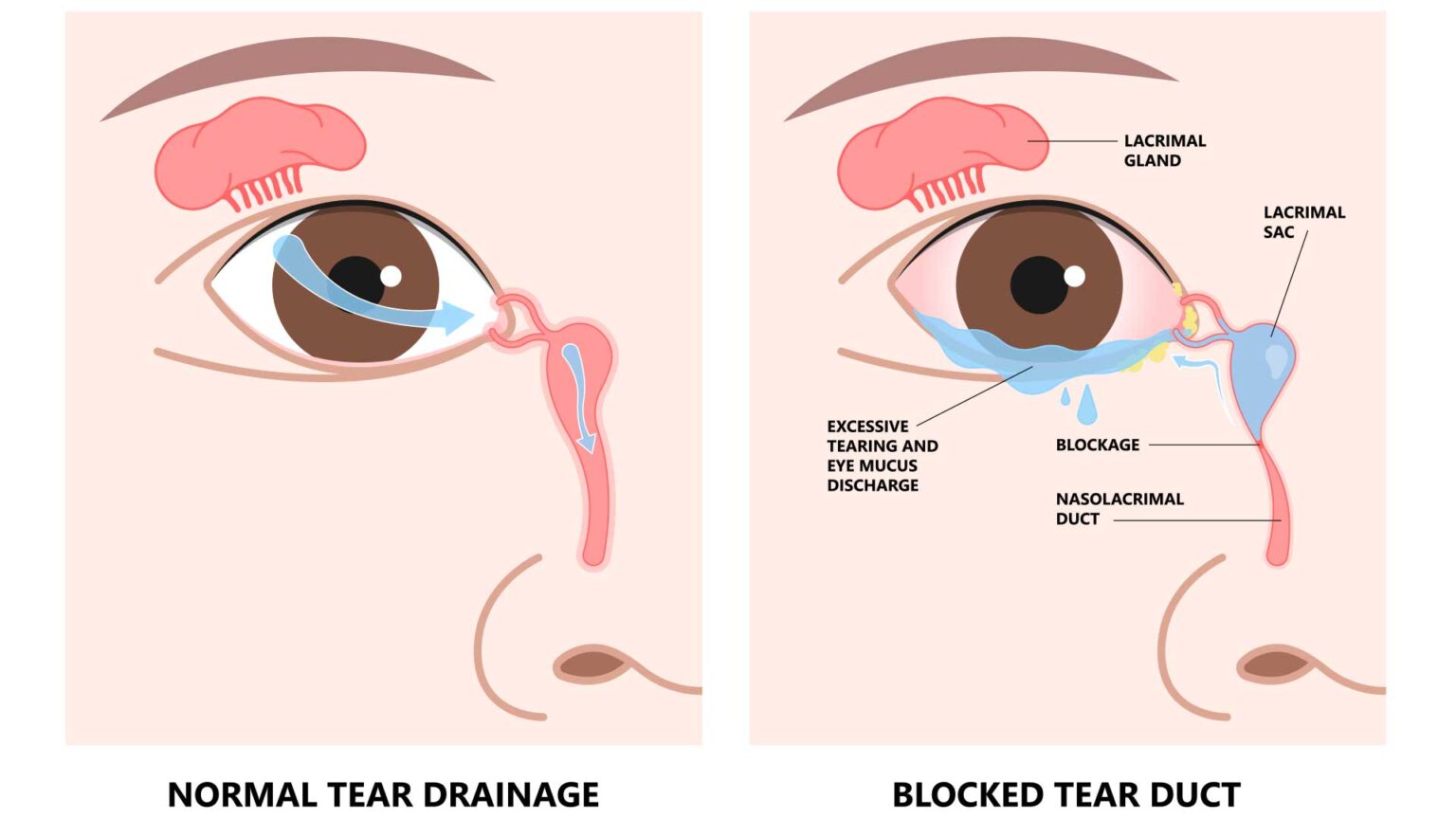 Understanding Epiphora: Persistent Watery Eyes Explained