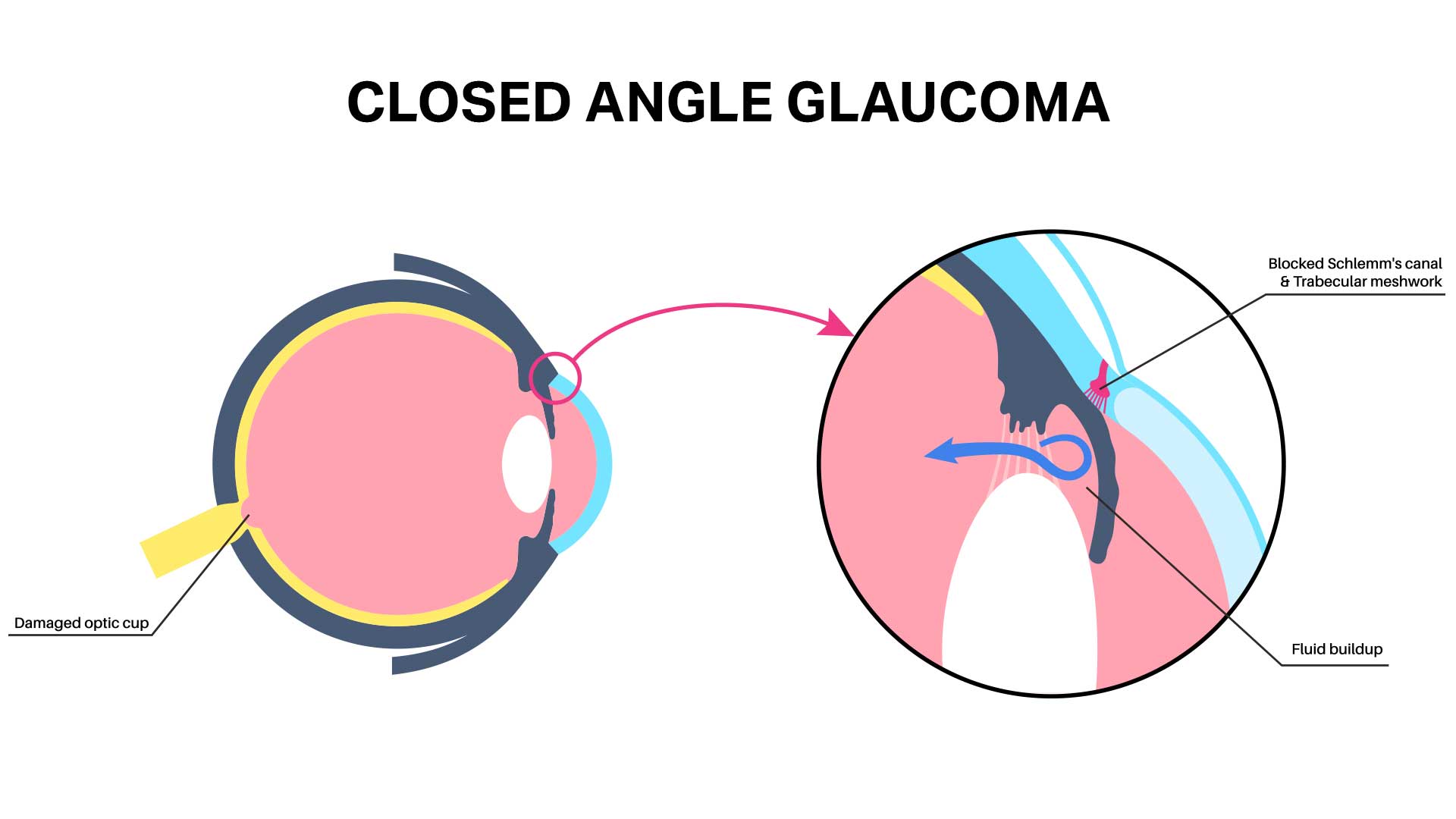 Comprehensive Care for Acute Closed Angle Glaucoma in London