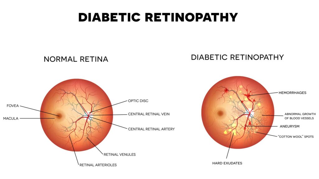 Maculopathy Vs Retinopathy Your Diabetic Eye Guide