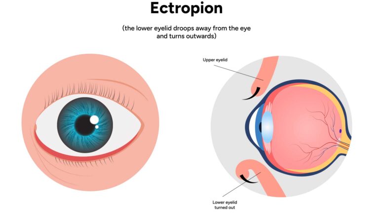 Understanding Epiphora: Persistent Watery Eyes Explained