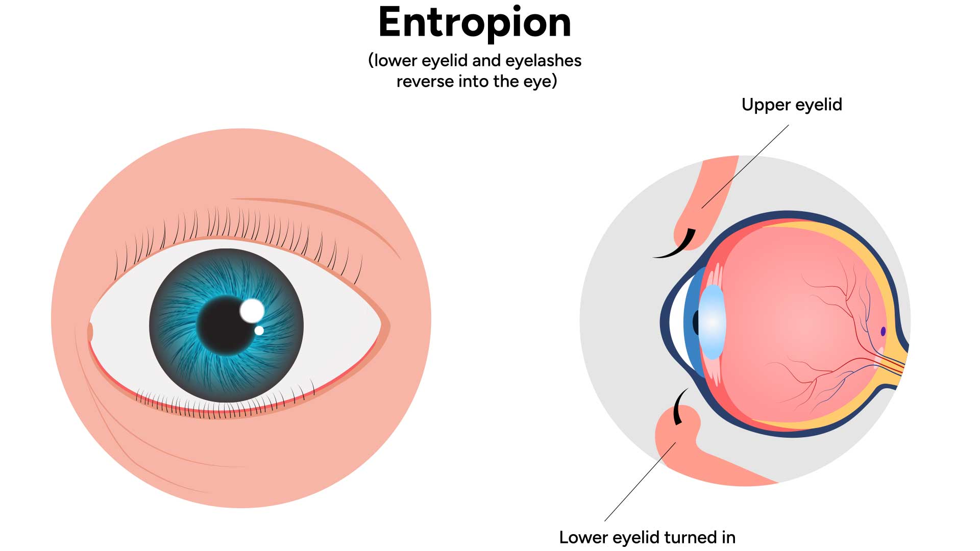 Understanding Epiphora: Persistent Watery Eyes Explained