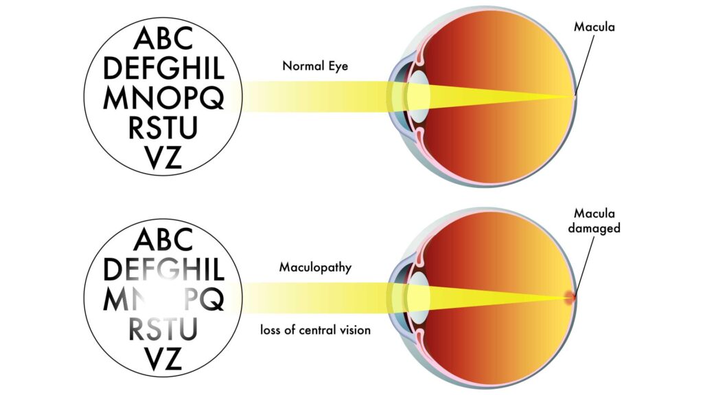 Diabetic Maculopathy: London's Expert Guide to Eye Health