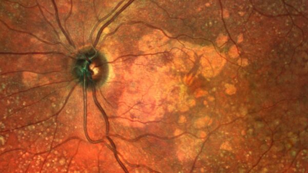 Optical Coherence Tomography (OCT) Scan: What is it?