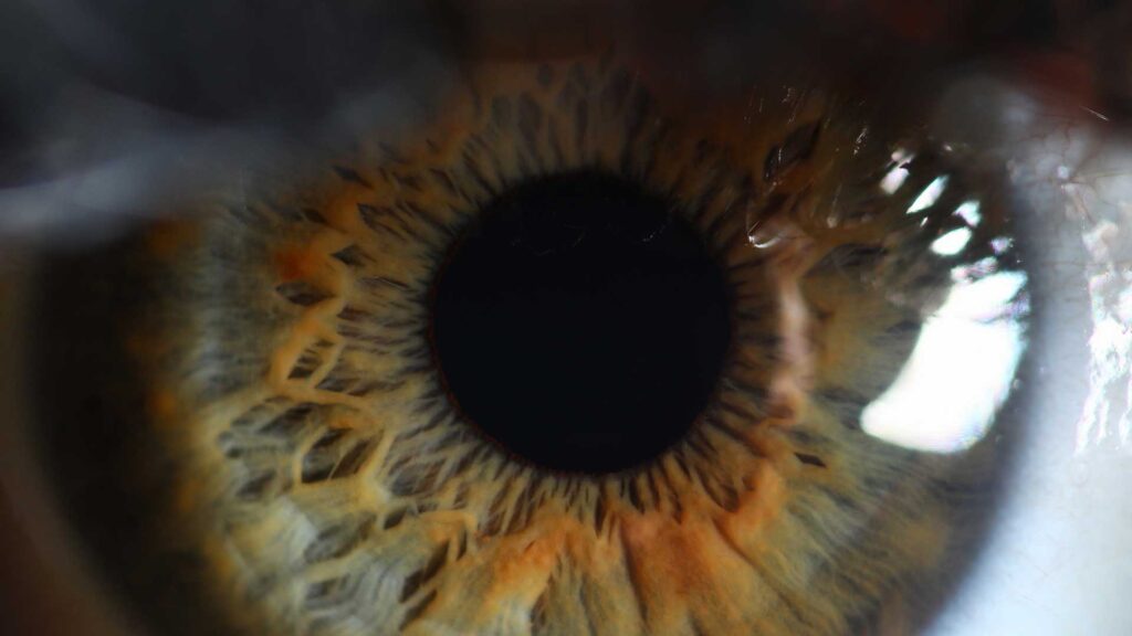 Presbyopia vs Astigmatism: London Eye Clinic Explains