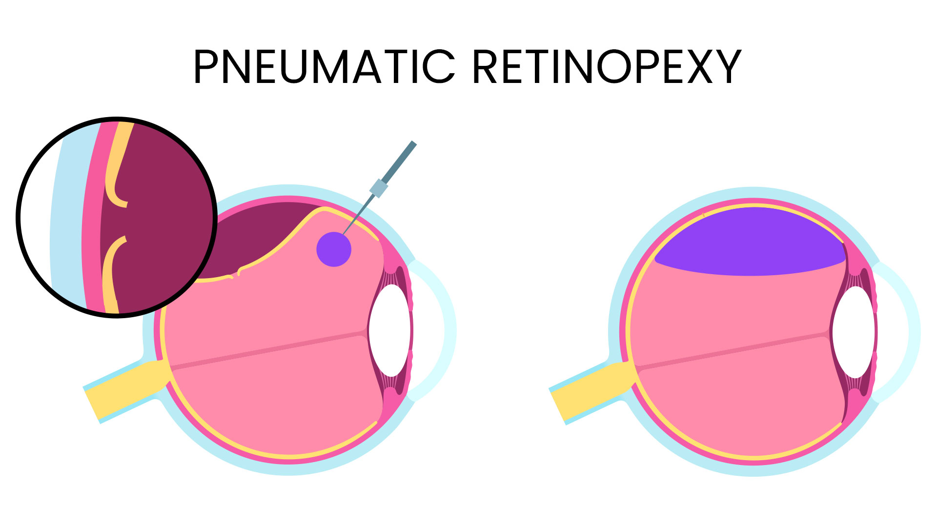 Desprendimiento de retina: causas, síntomas y tratamiento