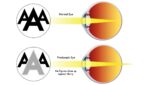 Presbyopia vs Astigmatism: London Eye Clinic Explains