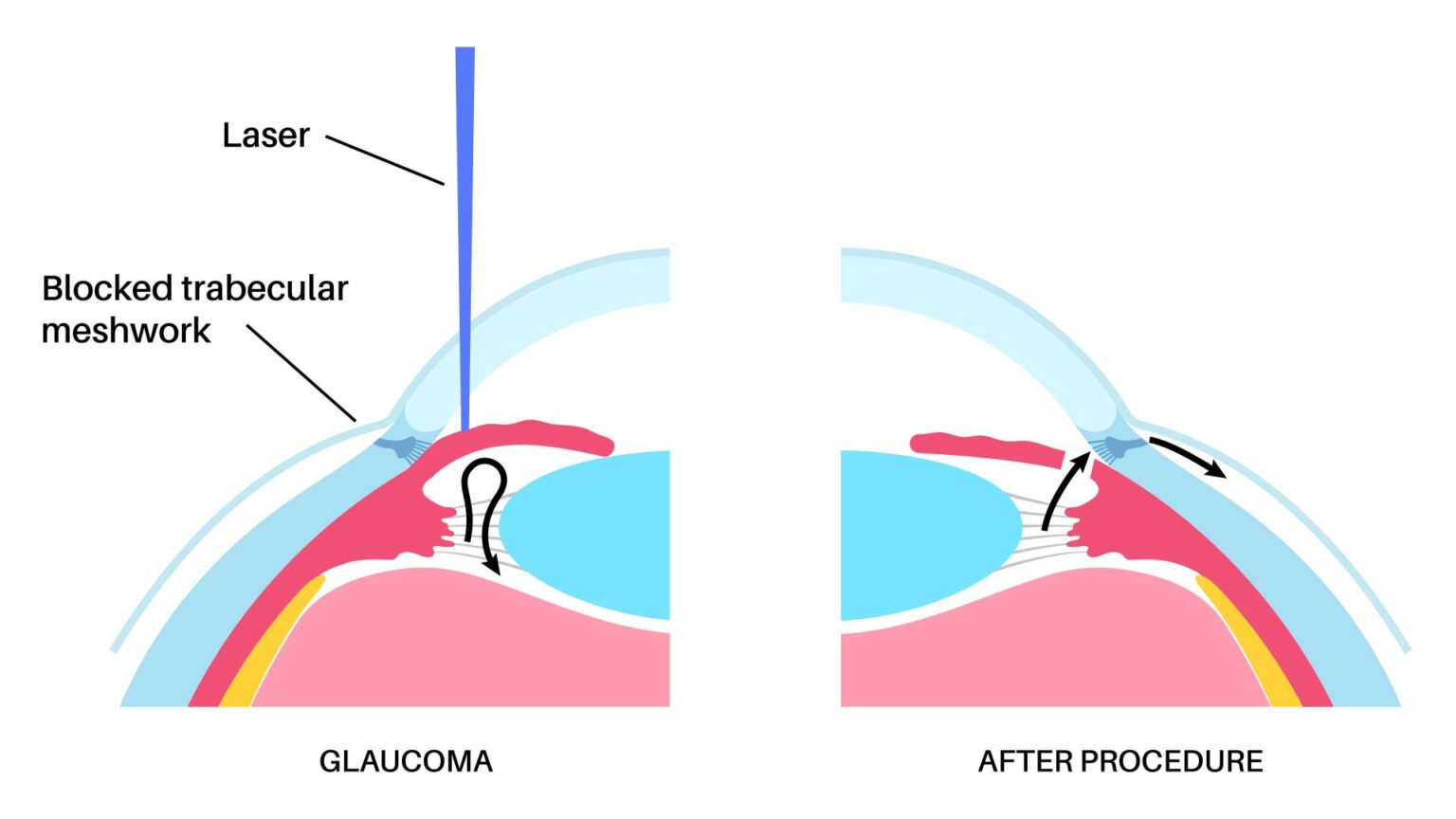 Safeguard Your Sight: YAG Laser Iridotomy in London
