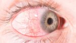Unravelling Eye Inflammation: Episcleritis vs Scleritis
