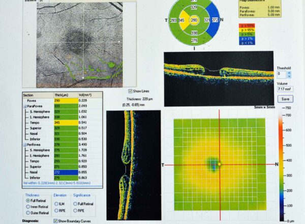 Macular Holes: London Eye Clinic's Comprehensive Overview