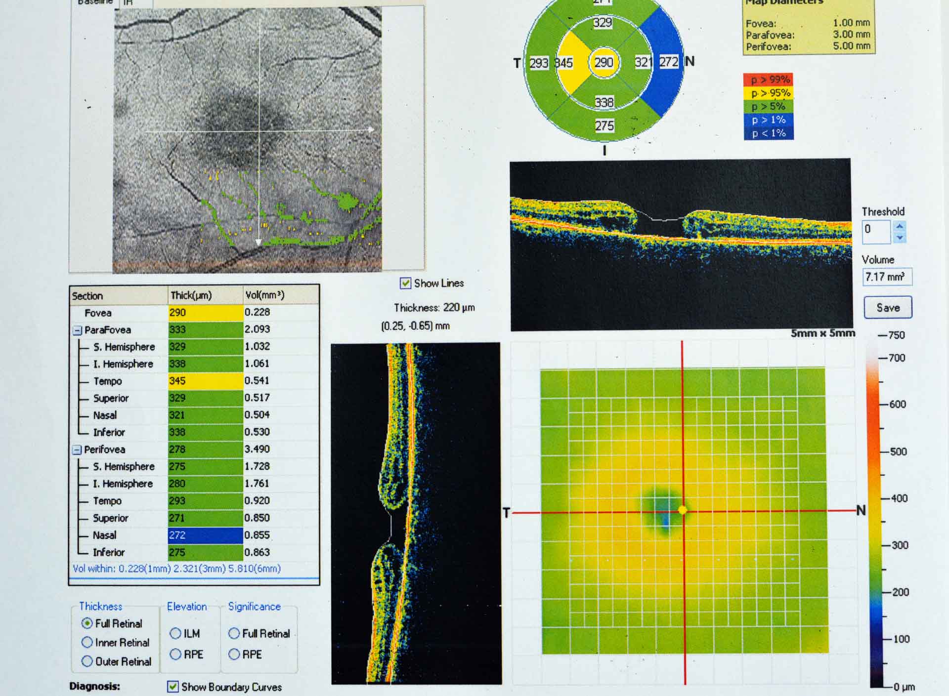 Macular Holes: Blue Fin Vision® Overview