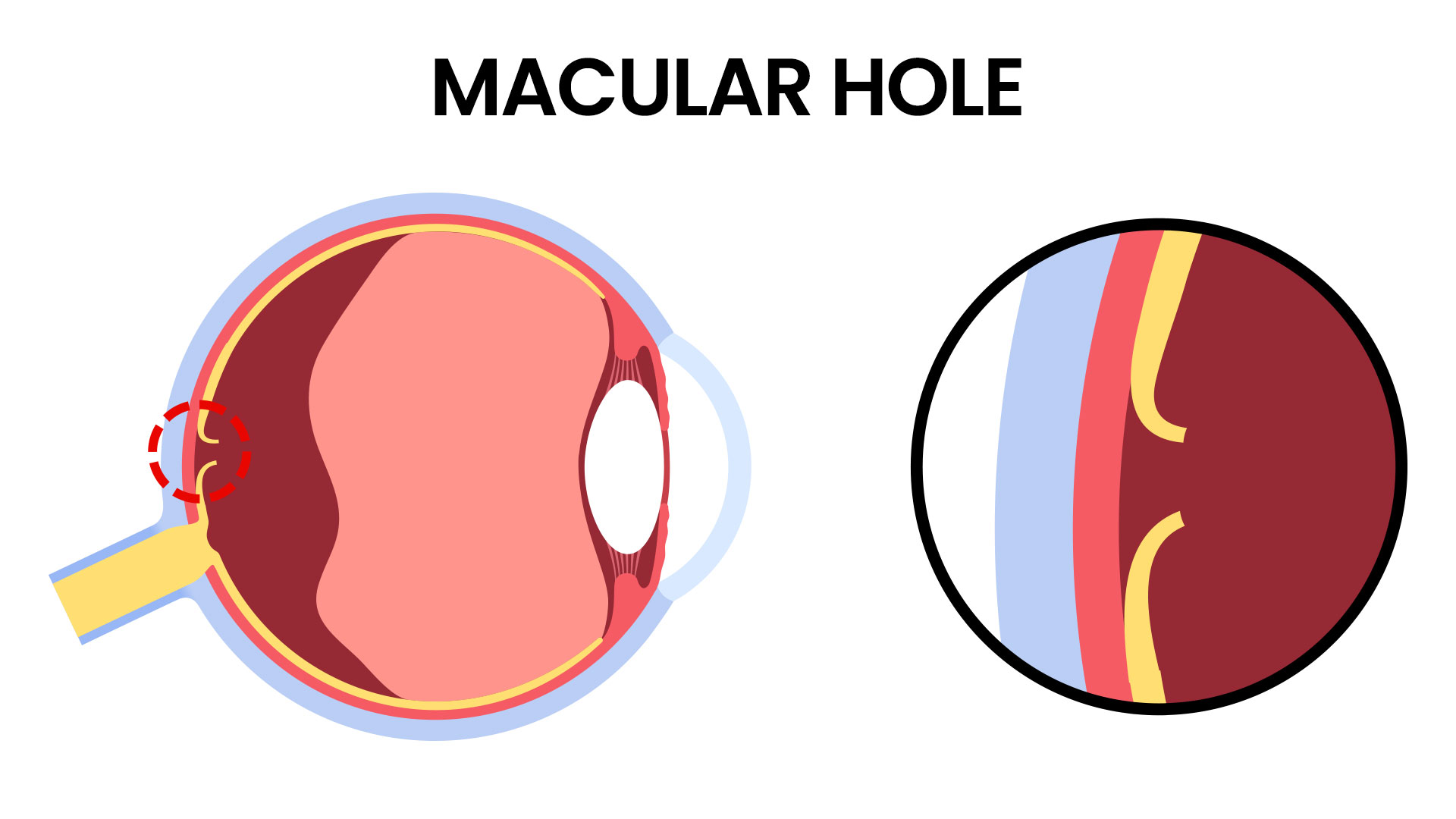 Macular Holes: London Eye Clinic's Comprehensive Overview