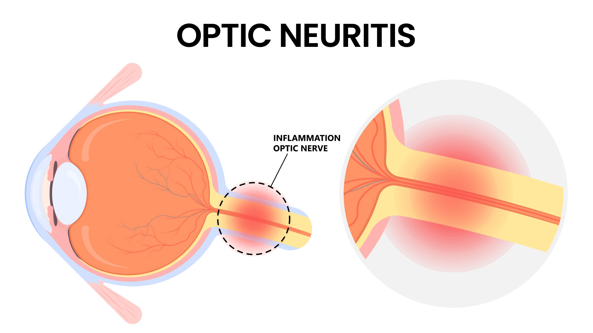 Optic Neuritis Unveiled: London Eye Experts Explain All