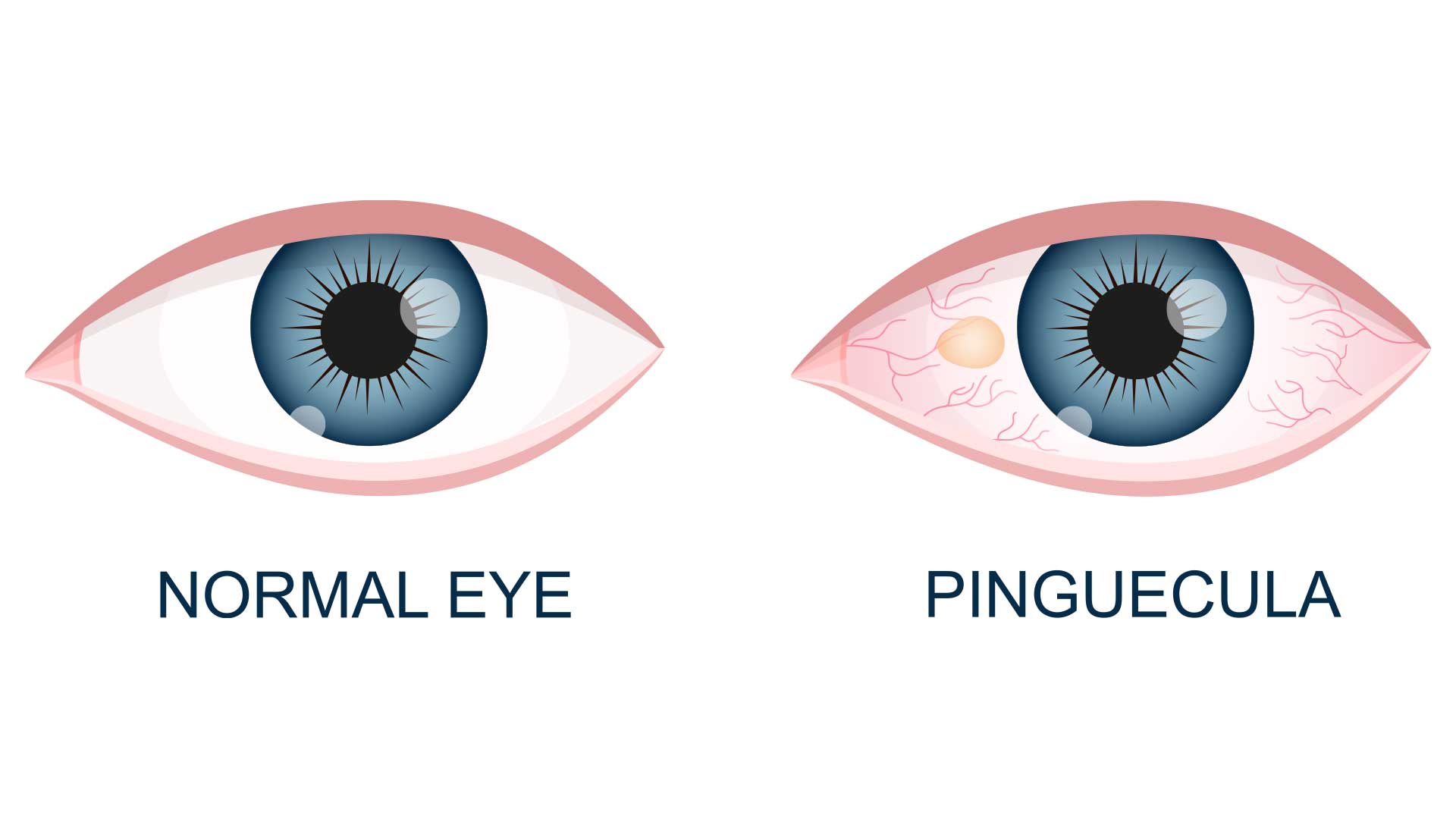What Is A Pinguecula Causes Symptoms Treatment