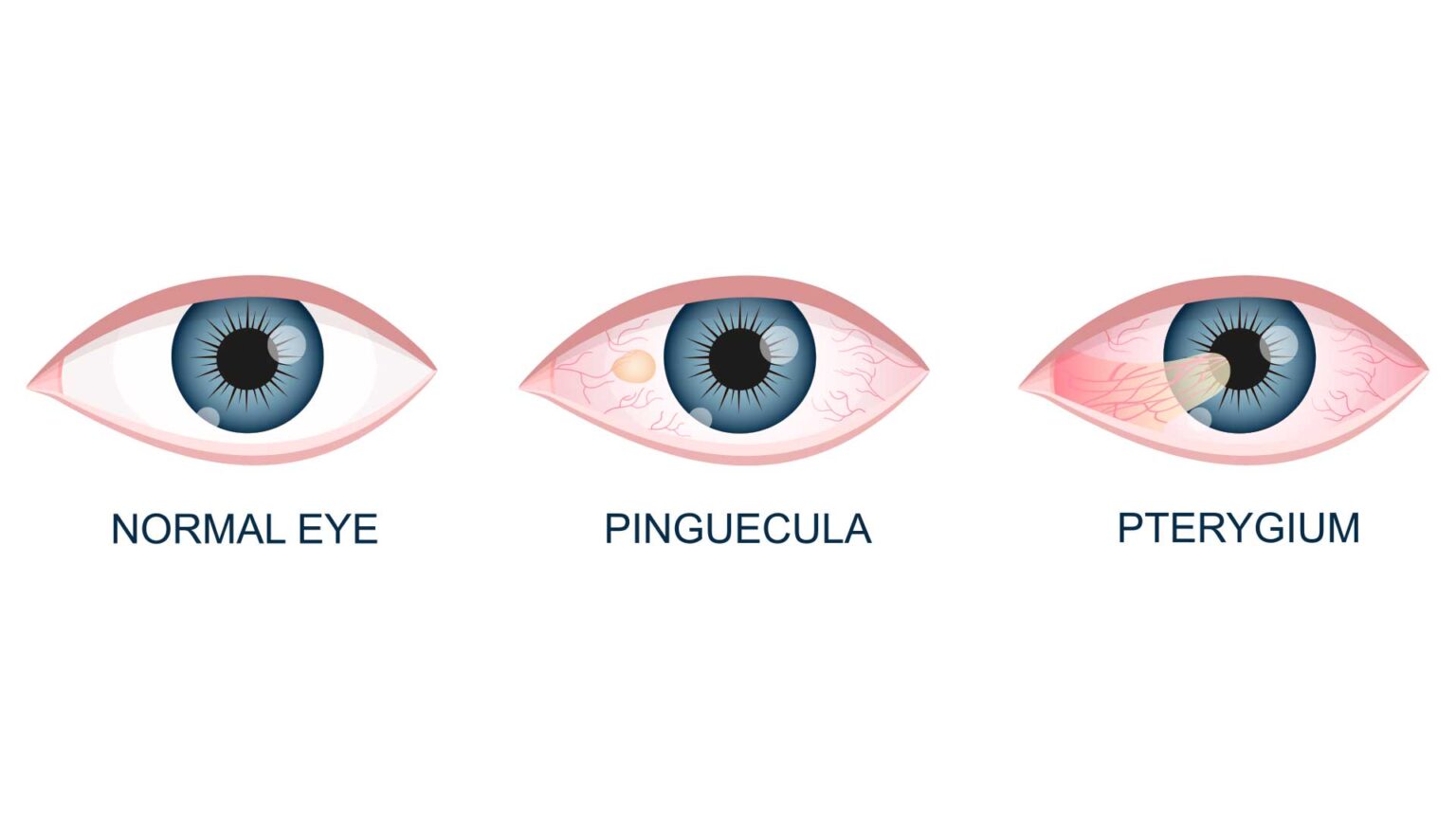 Pinguecula vs Pterygium: Harley Street Eye Clinic Guide