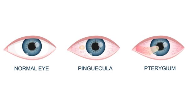 Pinguecula vs Pterygium: Harley Street Eye Clinic Guide