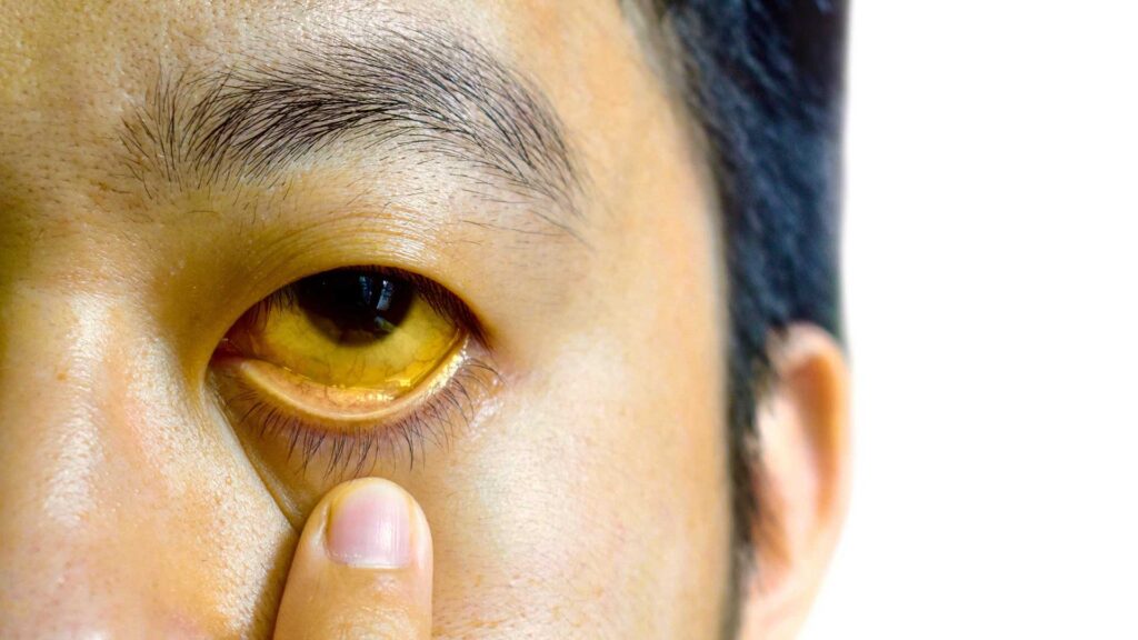 Yellow Eyes Explained: London Eye Clinic's Vital Insights