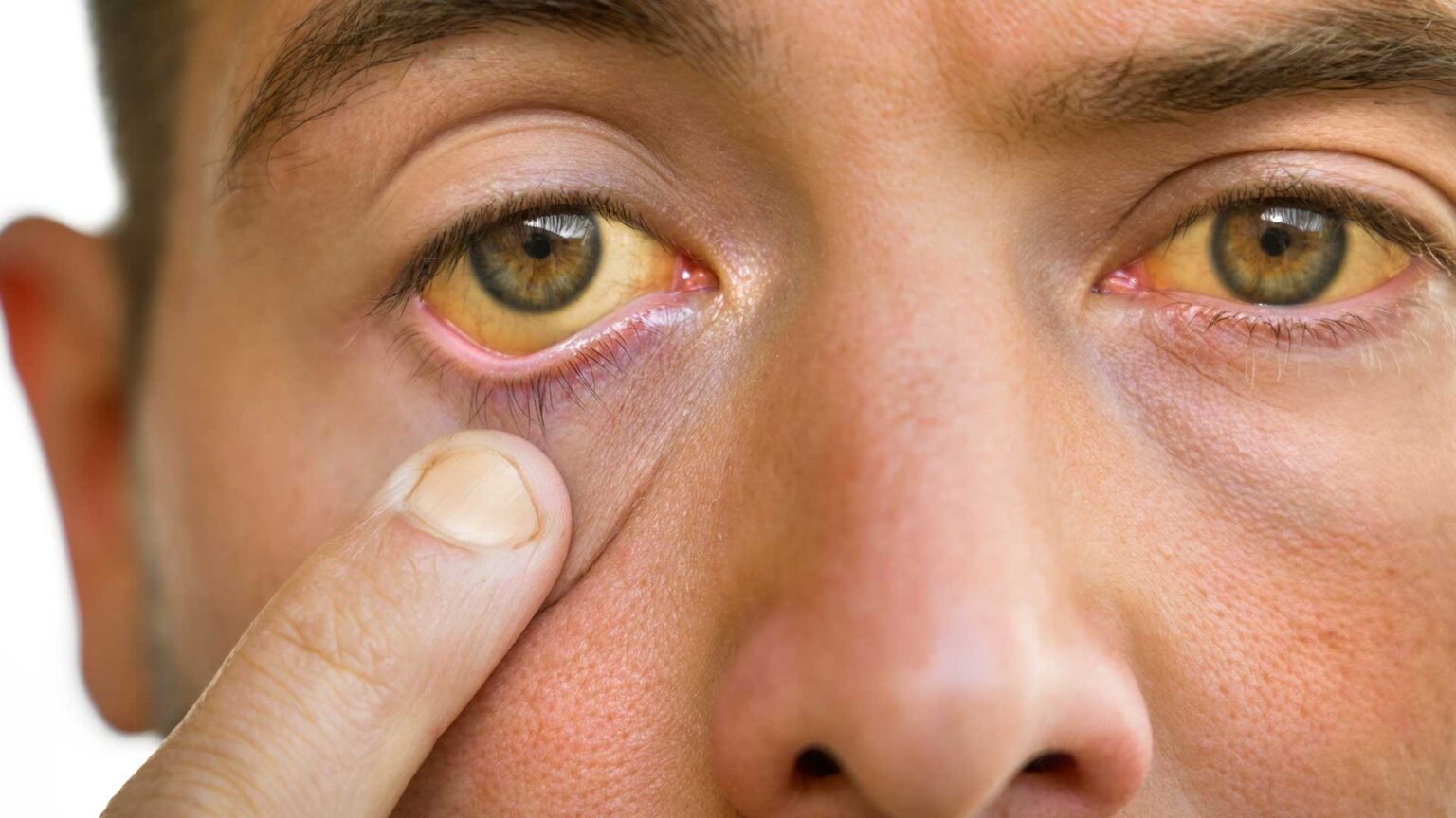 Yellow Eyes Explained: London Eye Clinic's Vital Insights