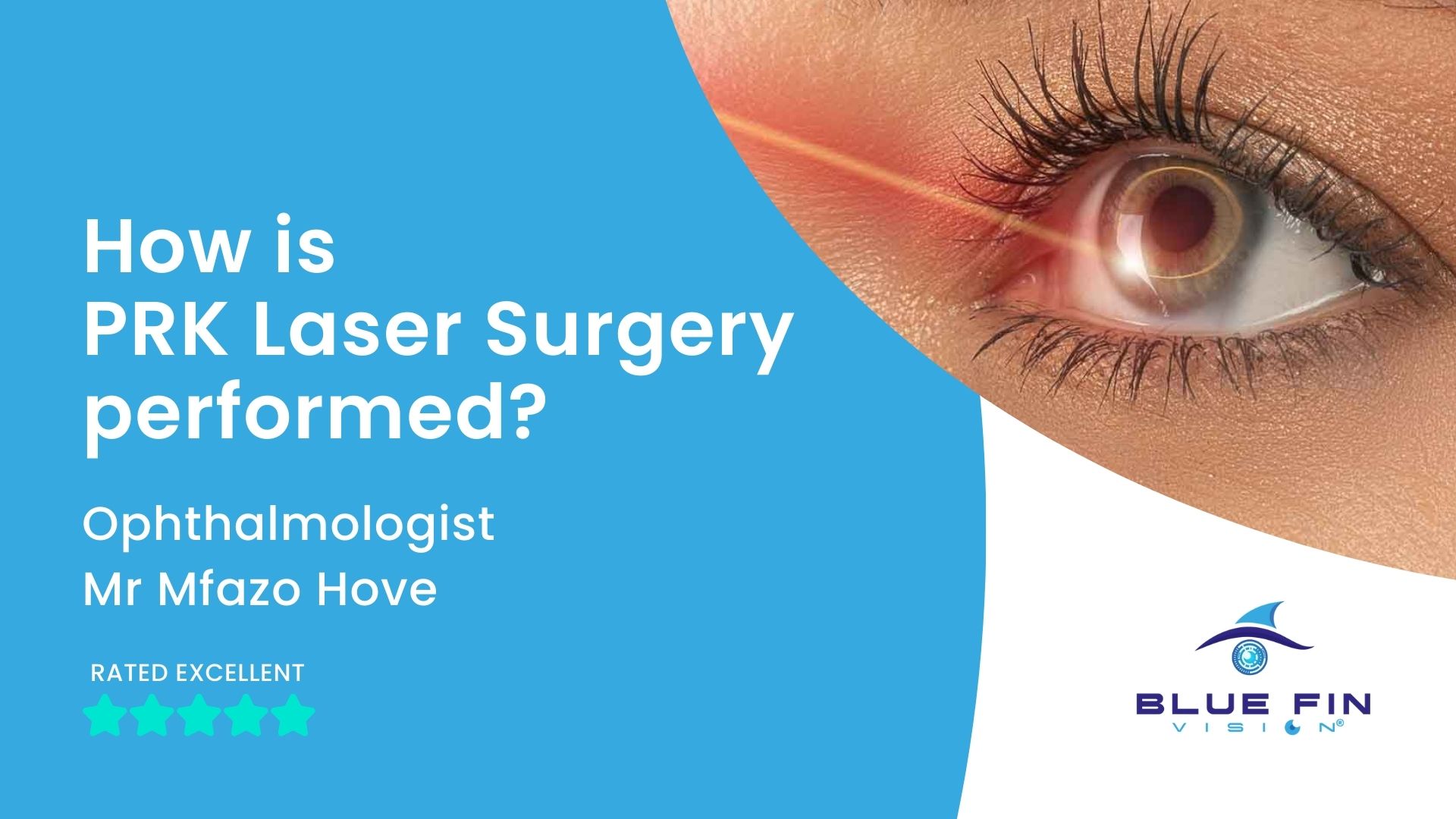 Blue Fin Vision® | How is PRK Laser Surgery performed?