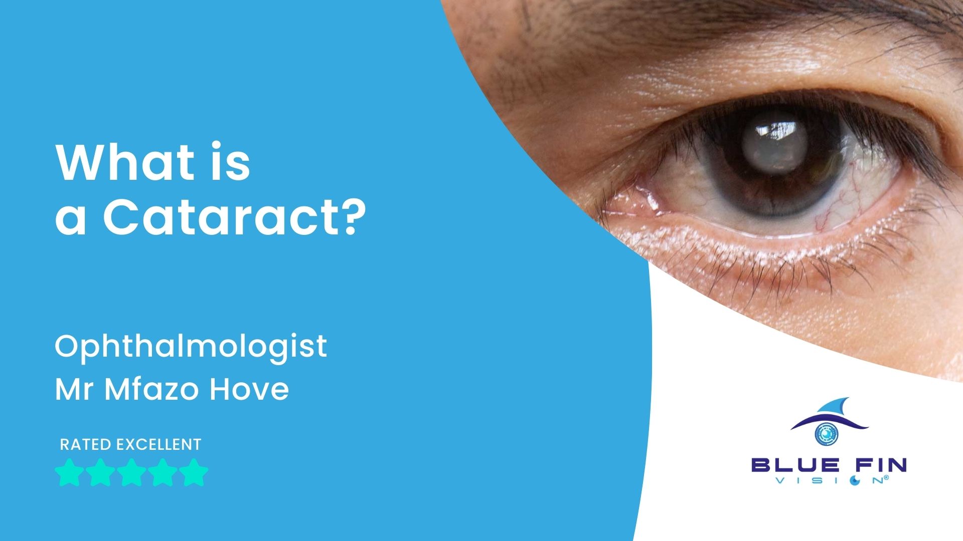 Blue Fin Vision® | What is a Cataract? Video Blog