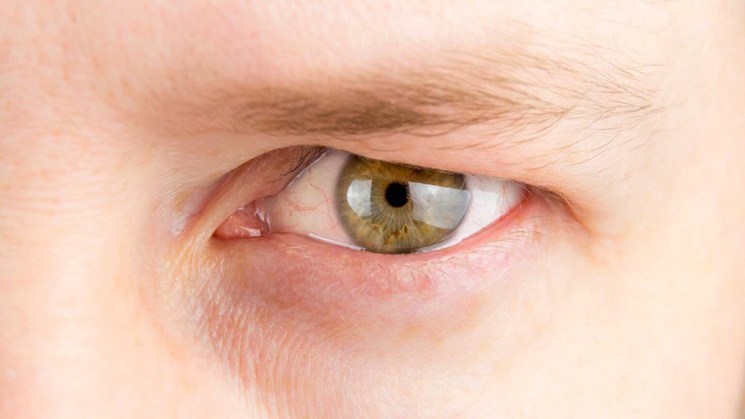 Blepharoplasty for Dermatochalasis: Expert Eyelid Surgery