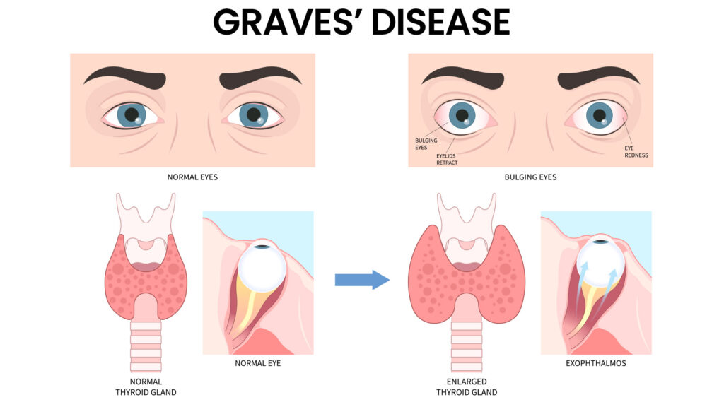 Recognising Thyroid Eye Disease Symptoms Early