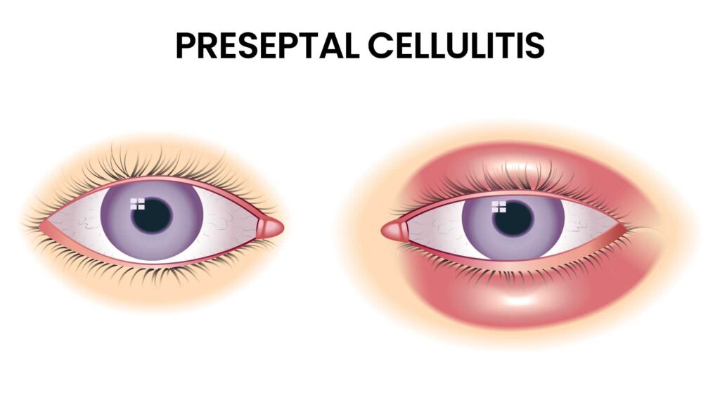 ¿Qué es la celulitis preseptal? Causas, síntomas y tratamiento