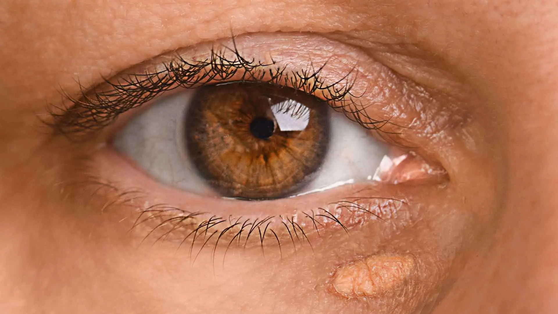 Best Xanthelasma Removal Hatfield | Top Eye Specialists