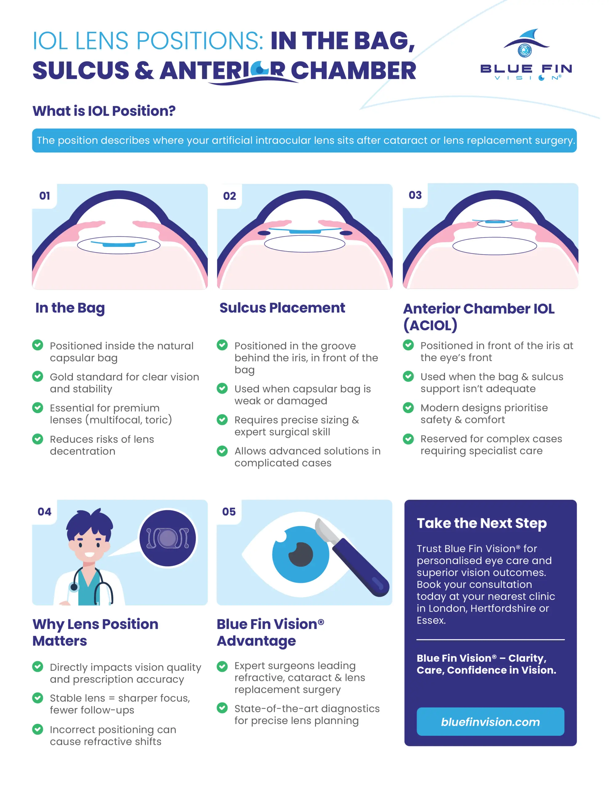 Blue Fin Vision® Guide to IOL Lens Positions & Eye Care